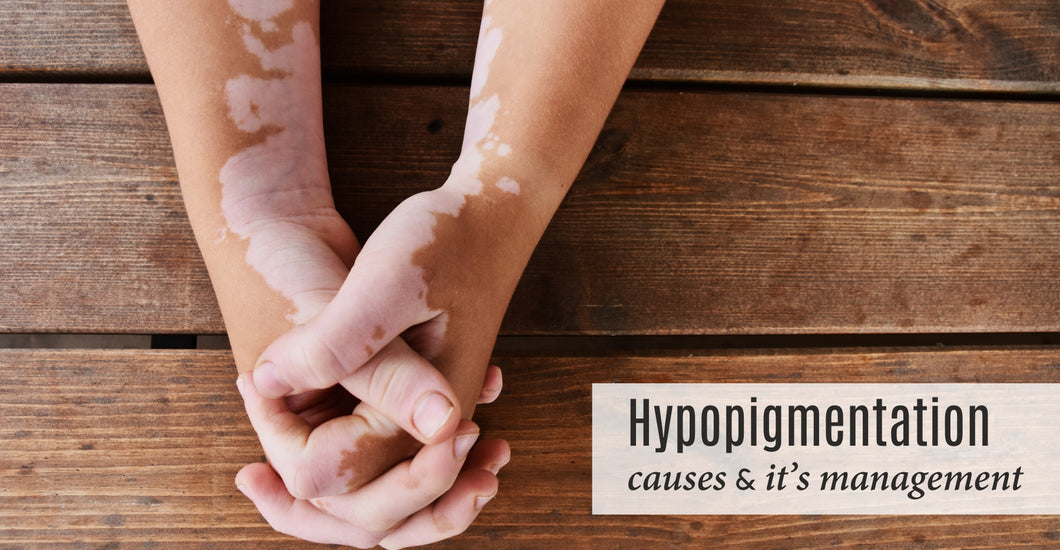 Hypopigmentation | what its causes, symptoms and management – Dr.JRK's Research and Pharmaceuticals
